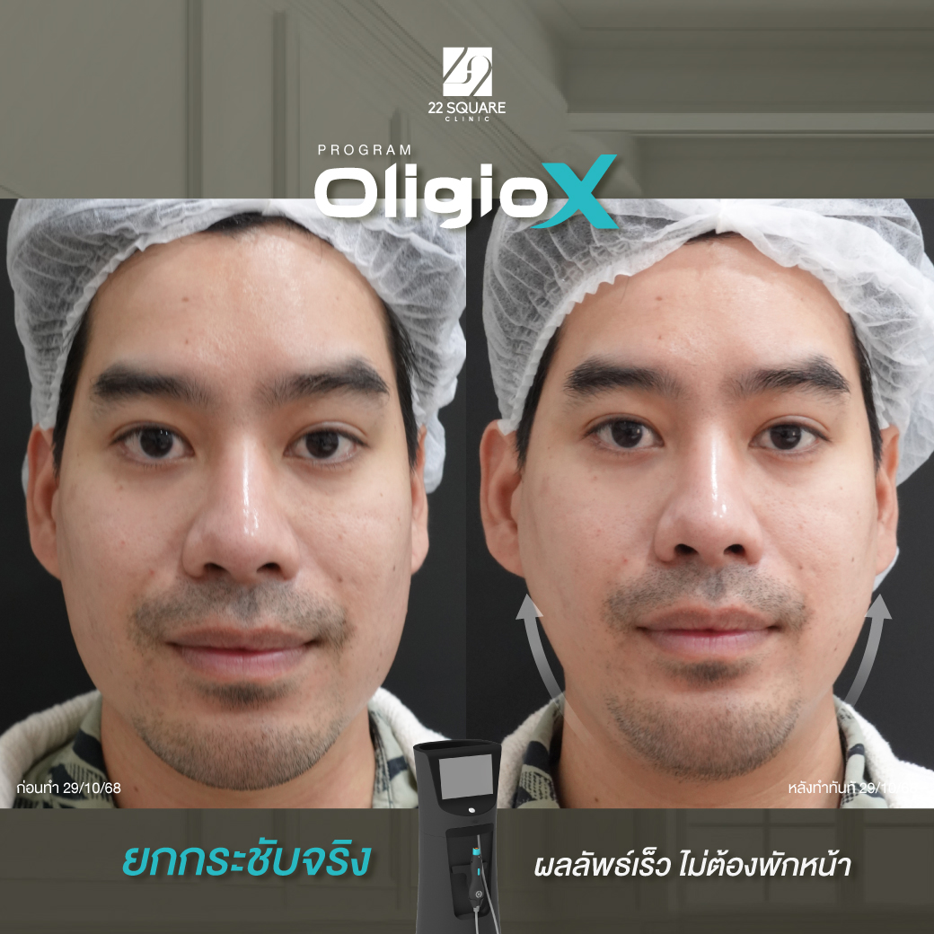 Oligio X Review – Real Skin Lifting with Instant Results at 22 Square ...