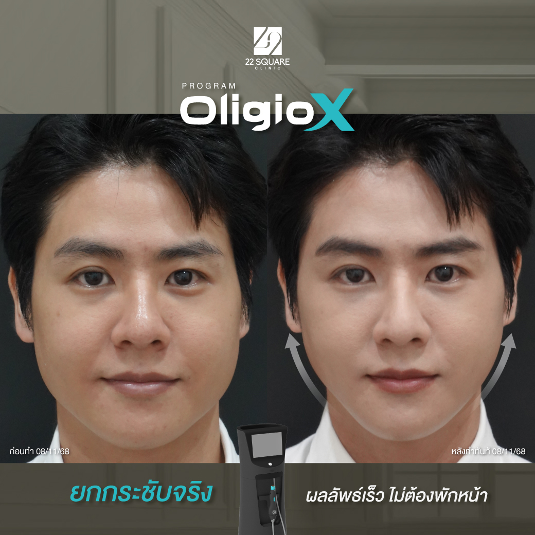 Oligio X Review – Real Skin Lifting with Instant Results at 22 Square ...
