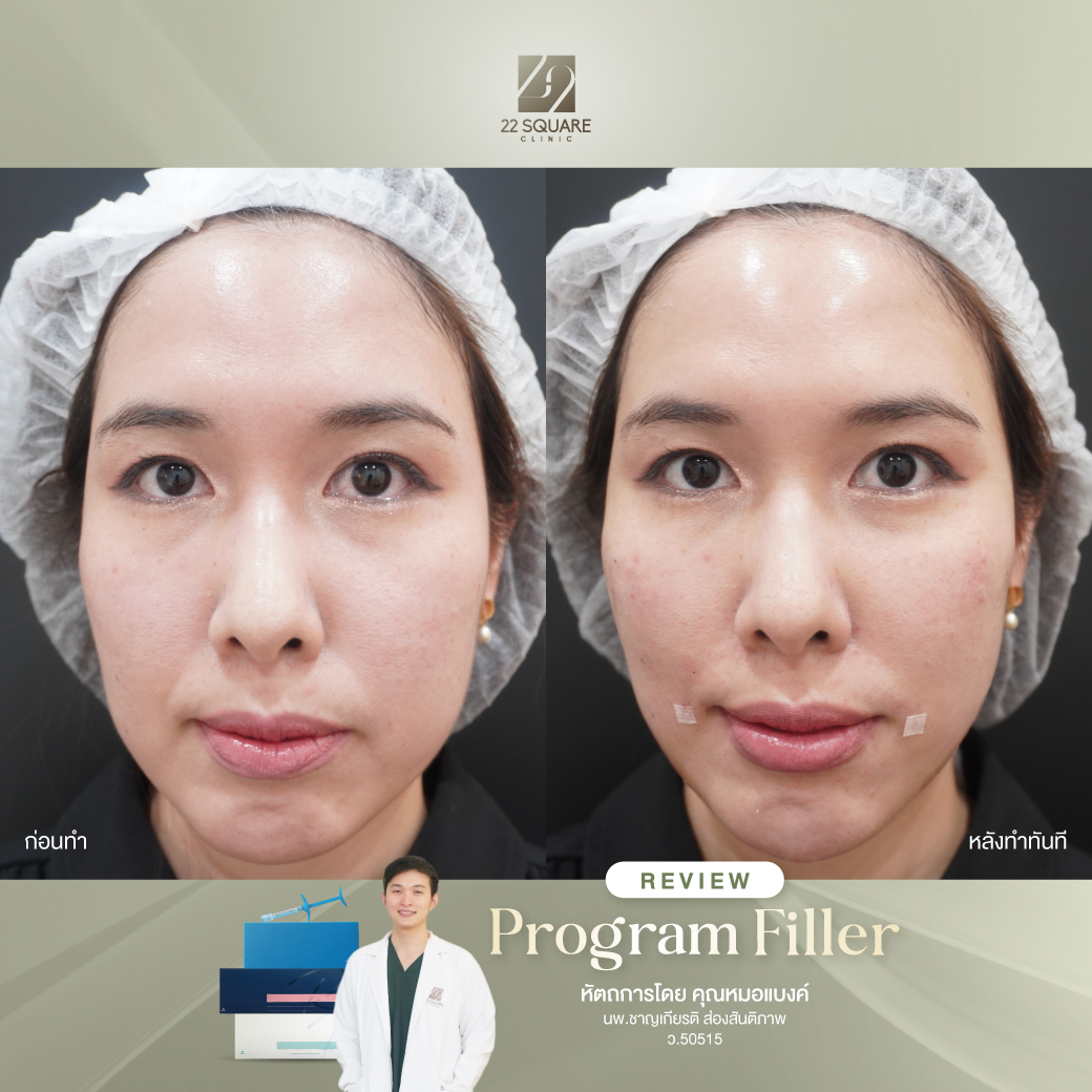 This Kind of Face — How Many CC of Filler Is Really Enough? | 22 Square ...